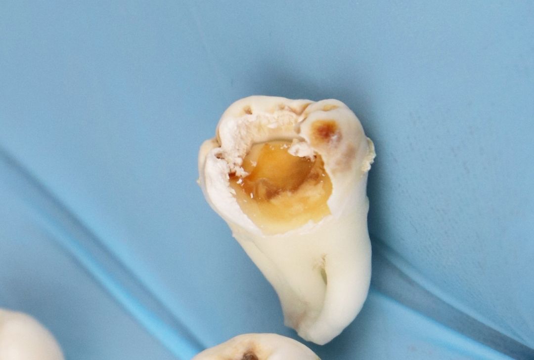 Tooth Decay - Causes and Solutions - UNISTAR DENTAL